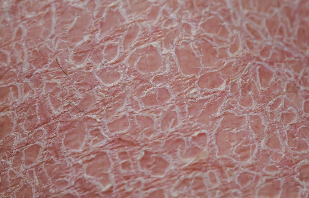 Why do light-skinned people shed more dead skin cells - Life's ...